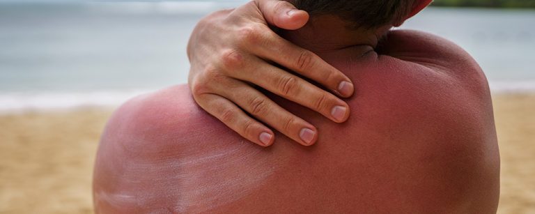 How to Use Zinc Oxide for Preventing and Treating Heat Rash - Citra ...
